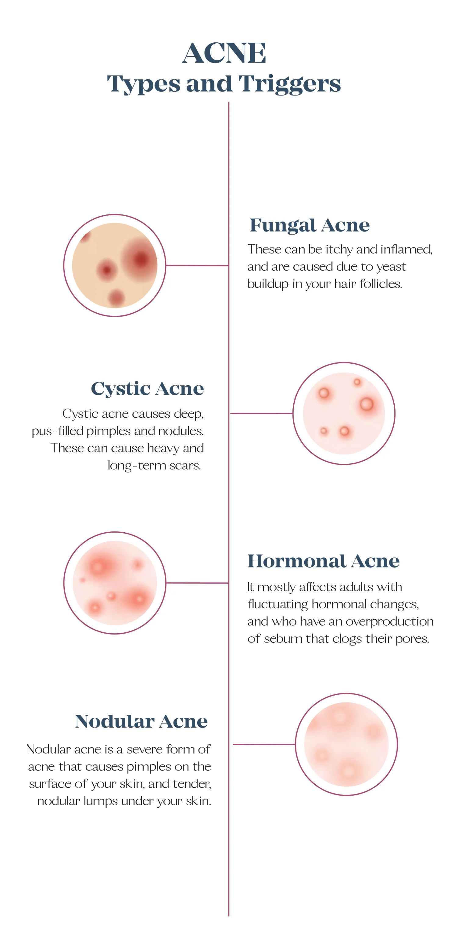 How to Identify Fungal Acne (And Why It’s Different from Regular Acne)